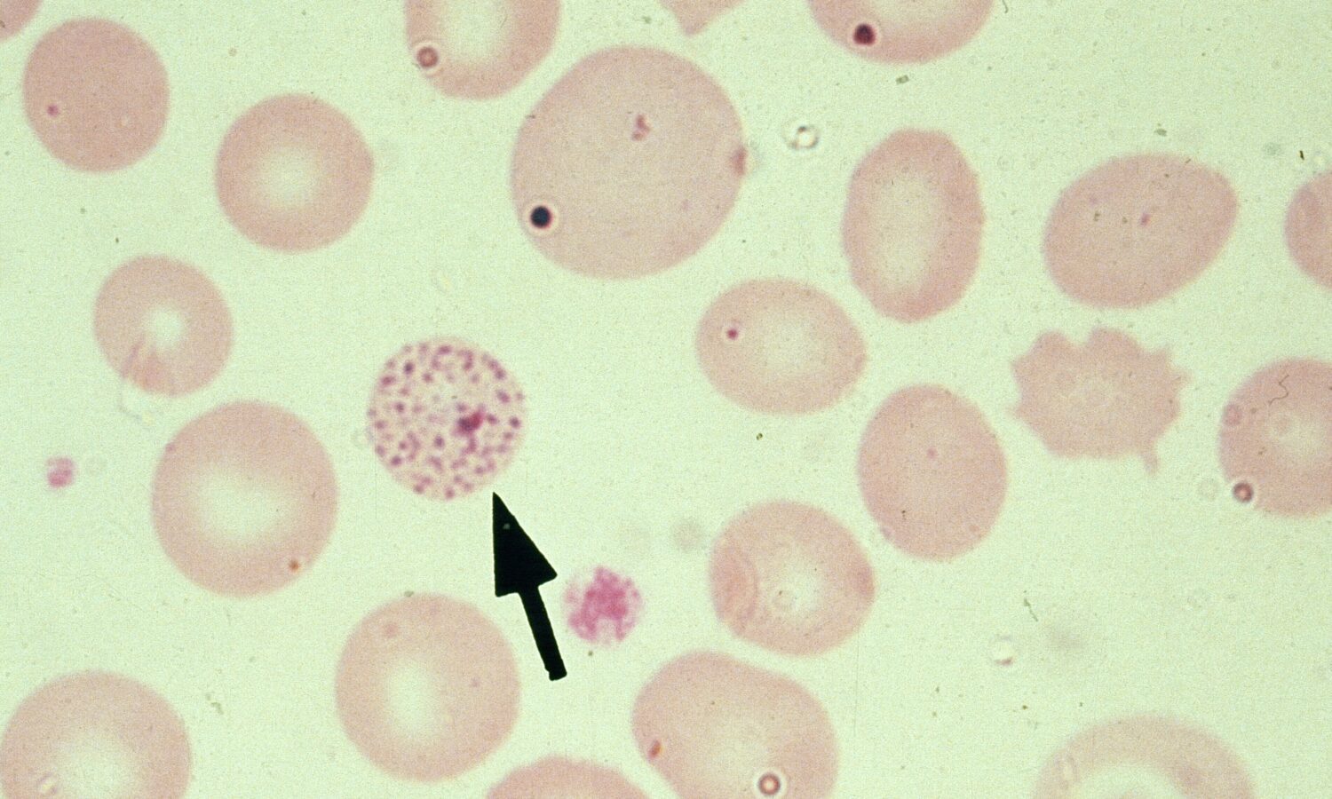 Fun Quiz: Hematology Cell Identification - The Mislabeled Specimen Fun ...