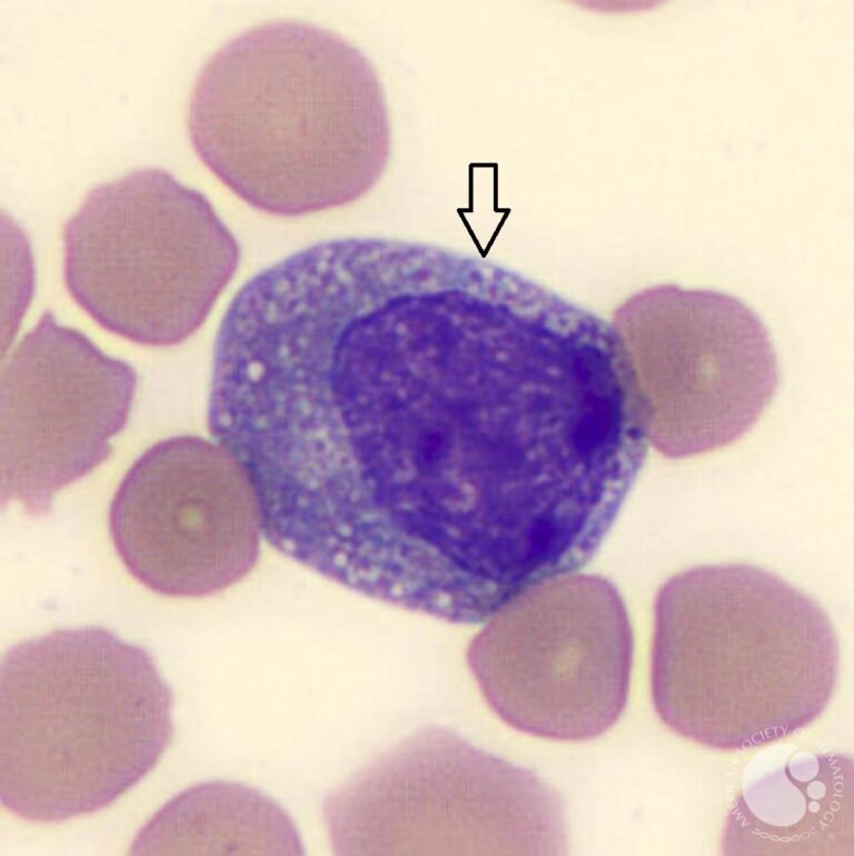 Fun Quiz: Hematology Cell Identification - The Mislabeled Specimen Fun ...